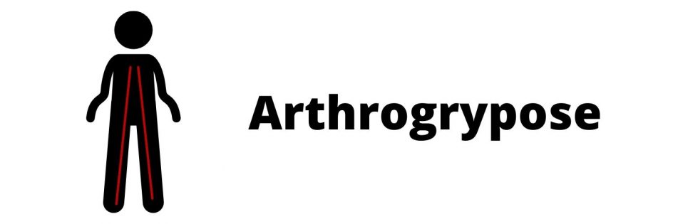 ARTHROGRYPOSE - Solutions Ergonomiques